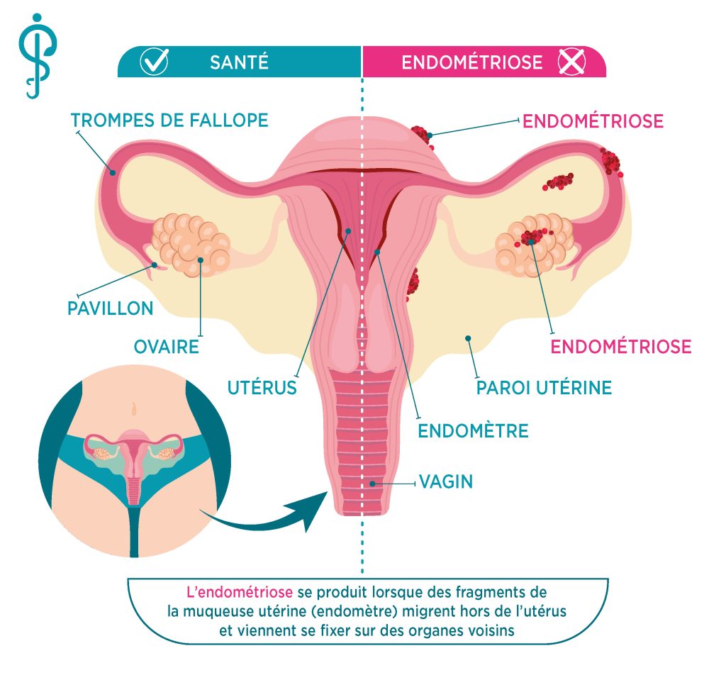 L'endométriose - Pôle Santé Saint Jean