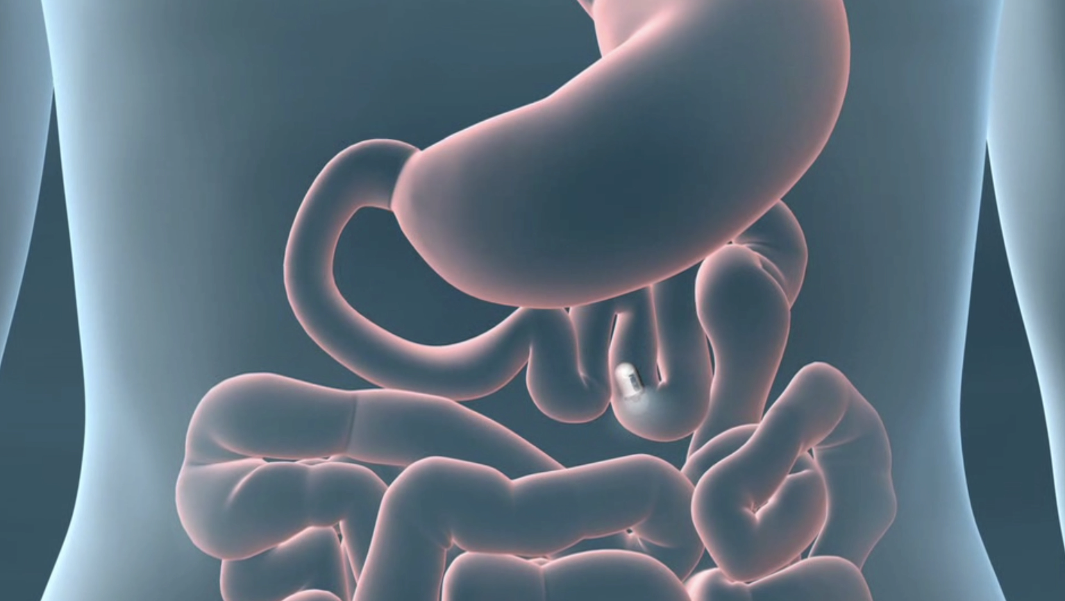 Vidéocapsule endoscopique de l’intestin grêle - Pôle Santé Saint Jean